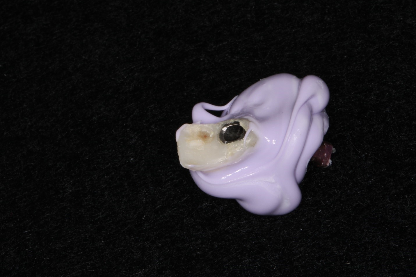 Optimizing outcome with palatally-placed implant in the esthetic zone ...