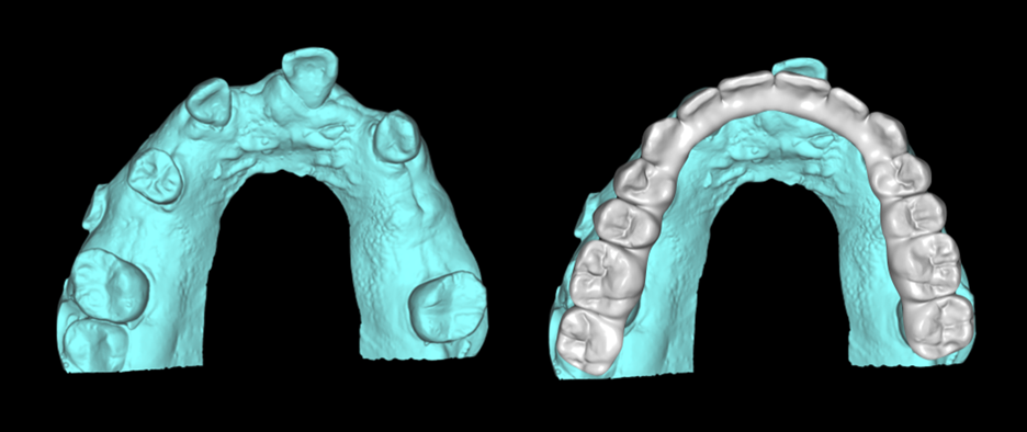 Digital workflows for conversions in full arch implant dentistry - Oral ...
