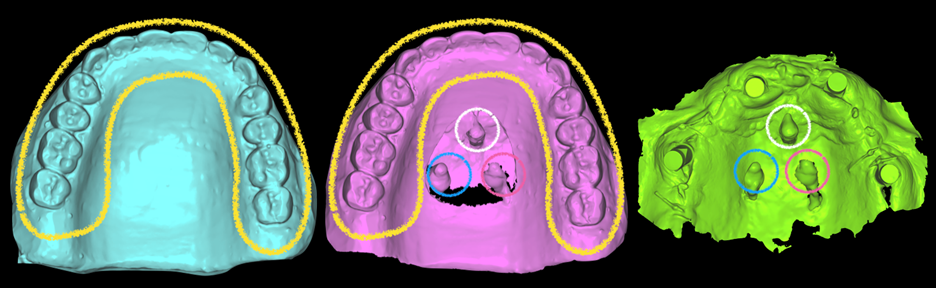 Digital workflows for conversions in full arch implant dentistry - Oral ...