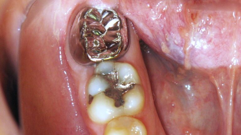 Stainless steel crowns for young permanent posterior teeth – An ...