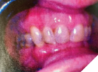 Multidisciplinary approaches to restoring vertical dimension of ...