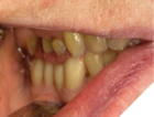 Multidisciplinary approaches to restoring vertical dimension of ...