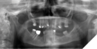 Multidisciplinary approaches to restoring vertical dimension of ...