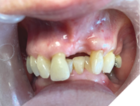 Multidisciplinary approaches to restoring vertical dimension of ...