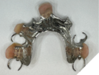 Multidisciplinary approaches to restoring vertical dimension of ...
