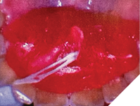 Multidisciplinary approaches to restoring vertical dimension of ...