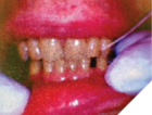 Multidisciplinary approaches to restoring vertical dimension of ...