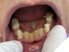 Multidisciplinary approaches to restoring vertical dimension of ...