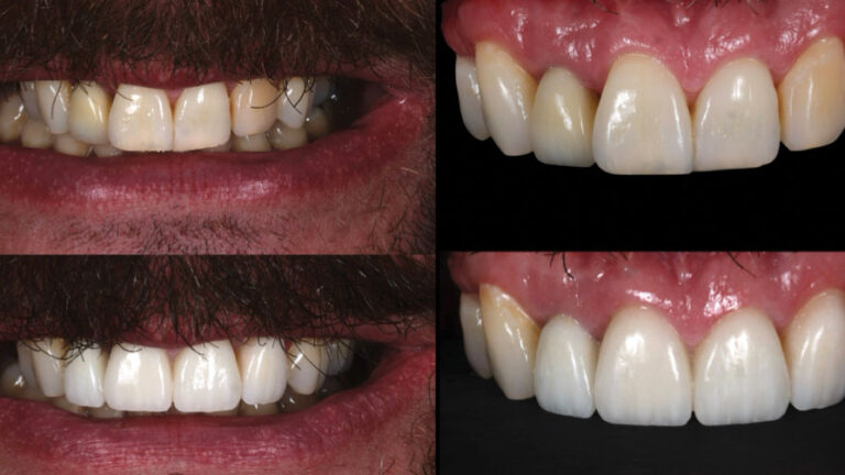 The importance of creating an illusion for malpositioned teeth - Oral ...