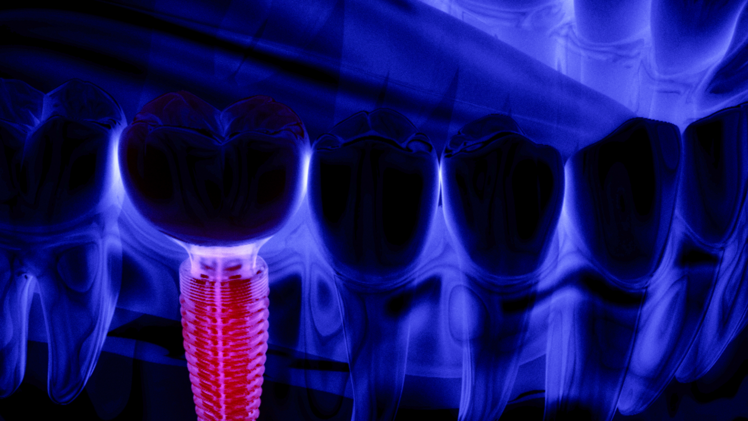 Are titanium micro-particles common around dental implants? A new study ...