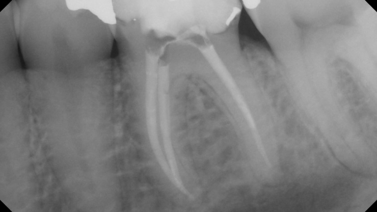 Reciproc blue: Is a one file endodontic procedure the new reality ...