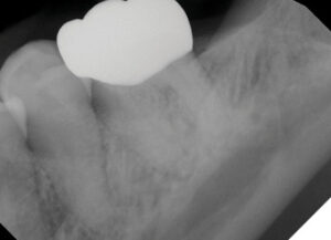 Reciproc blue: Is a one file endodontic procedure the new reality ...