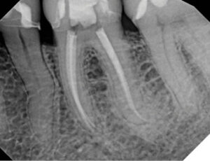 Reciproc blue: Is a one file endodontic procedure the new reality ...