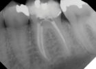 Reciproc blue: Is a one file endodontic procedure the new reality ...