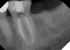 Reciproc blue: Is a one file endodontic procedure the new reality ...