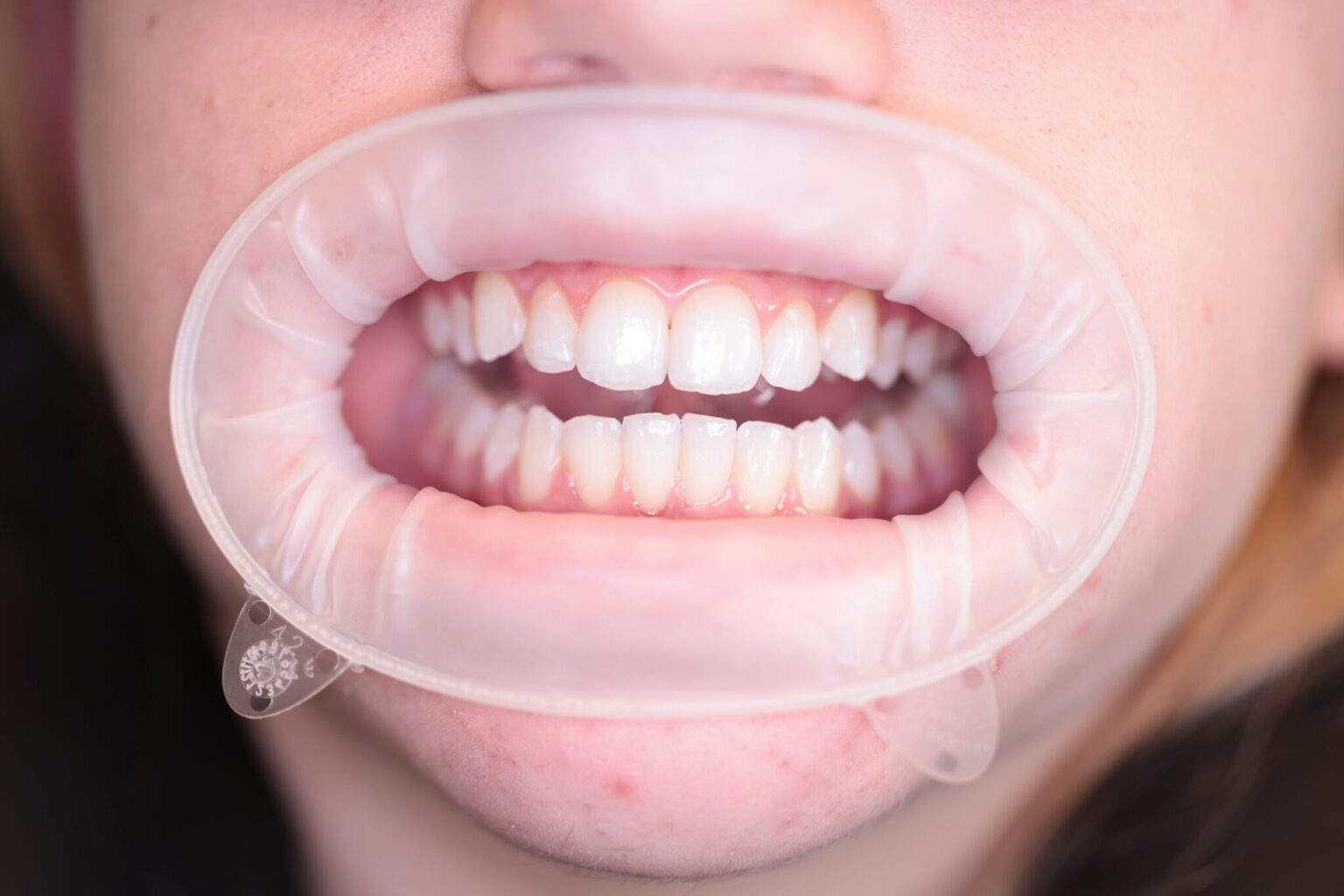 Precision and Predictability: Placing Clear Aligner Attachments with ...