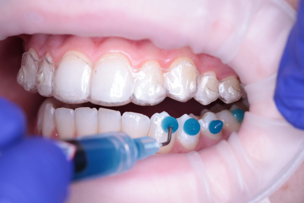 Precision and Predictability: Placing Clear Aligner Attachments with ...