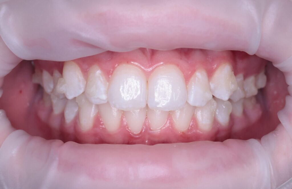 Precision and Predictability: Placing Clear Aligner Attachments with ...