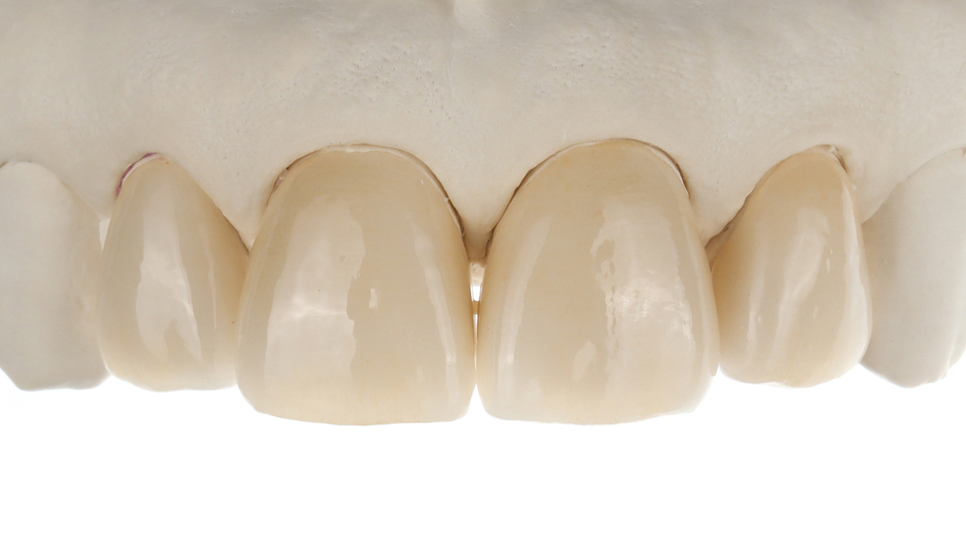 Restoring severely tetracycline-stained teeth with home whitening and ...