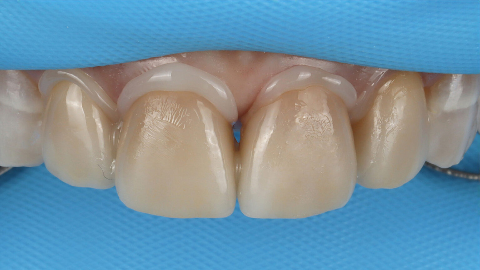 Restoring severely tetracycline-stained teeth with home whitening and ...
