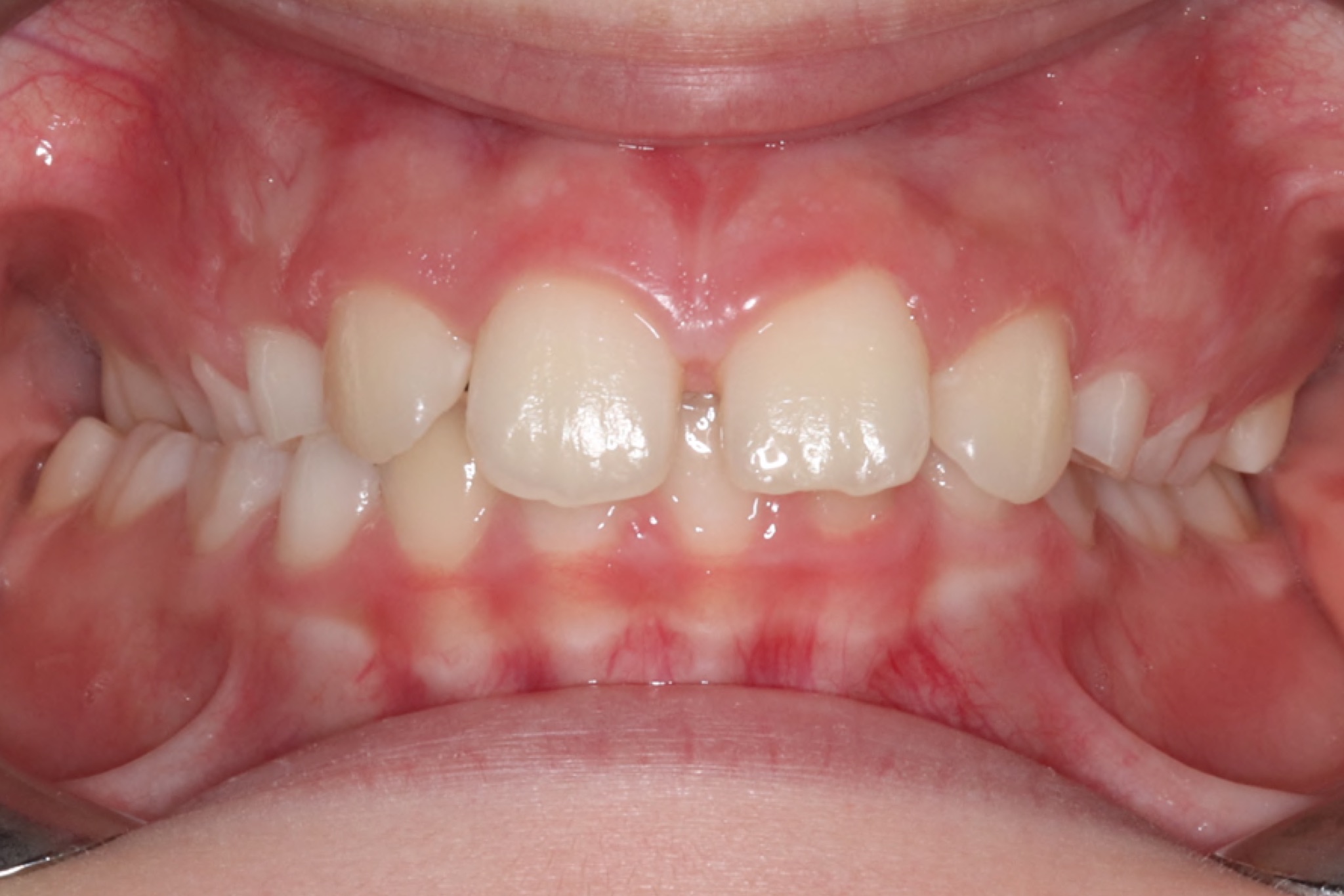 Recognizing the signs: When to refer for early orthodontic treatment ...