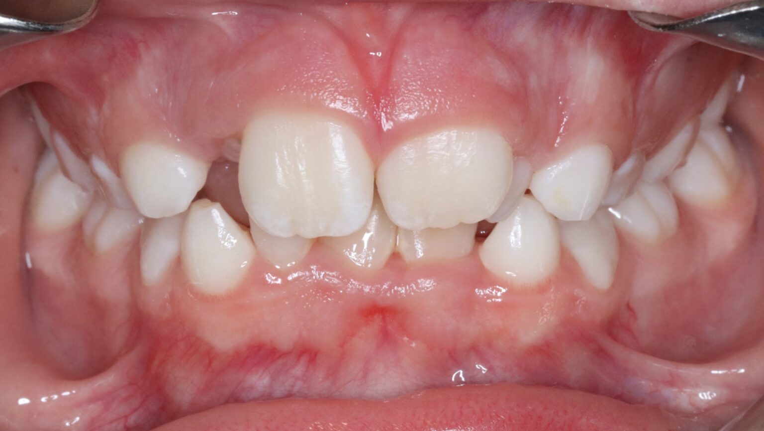 Recognizing the signs: When to refer for early orthodontic treatment ...
