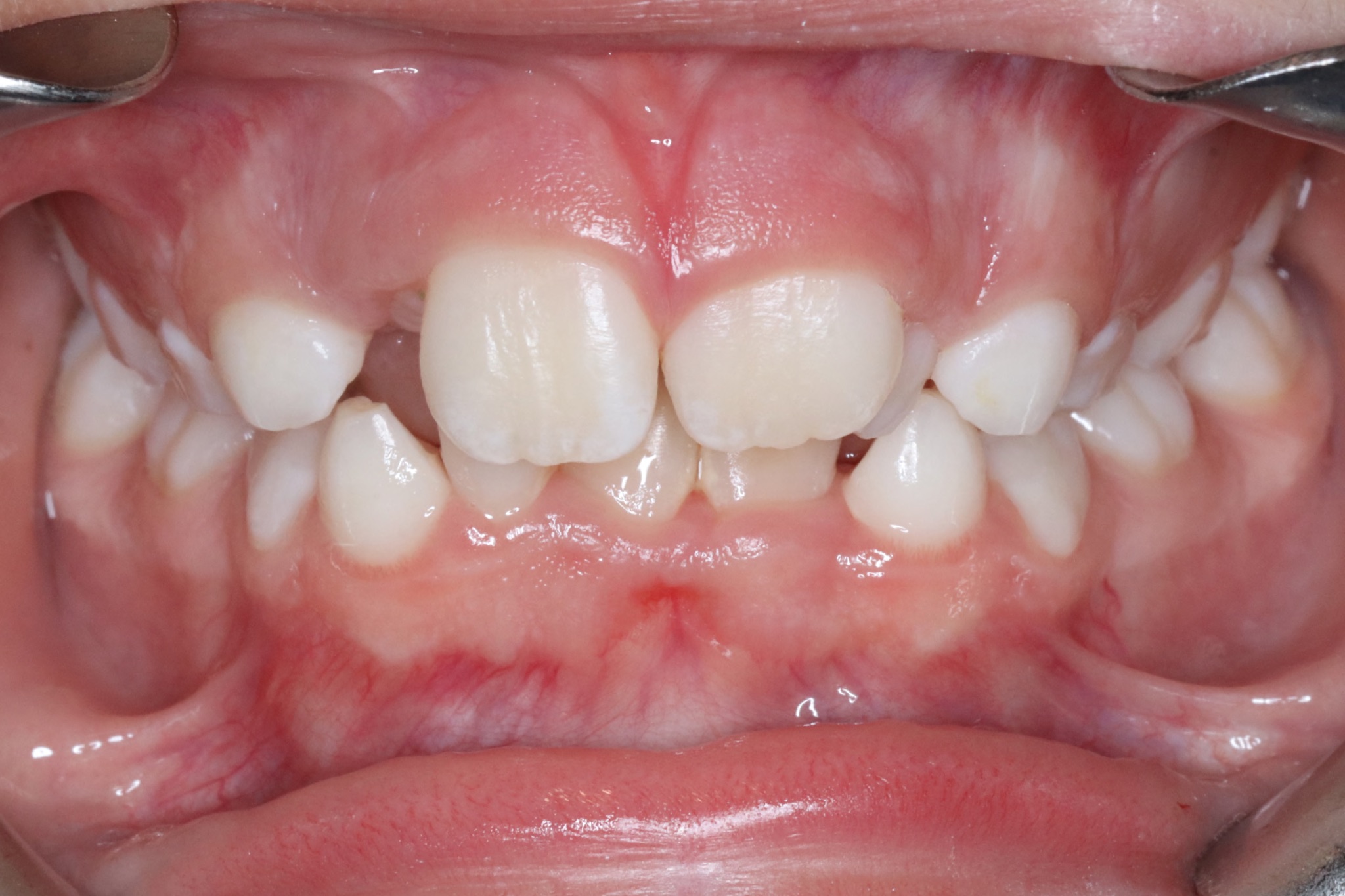 Recognizing the signs: When to refer for early orthodontic treatment ...