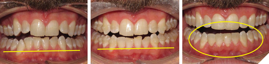 Conservative approach for the treatment of anterior tooth wear - Oral ...