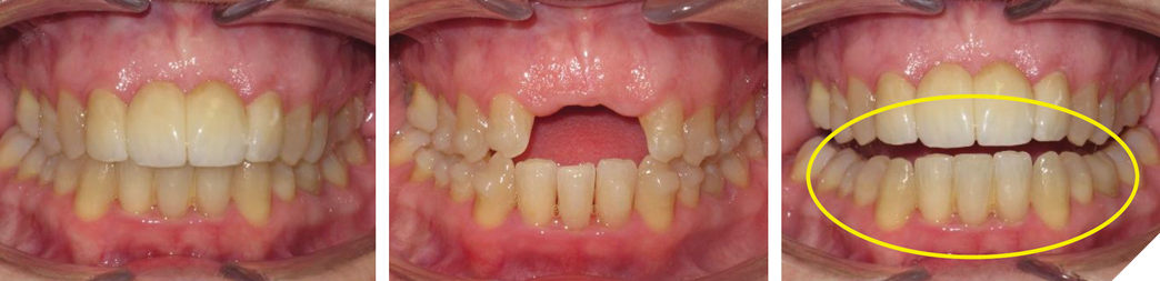 Conservative approach for the treatment of anterior tooth wear - Oral ...
