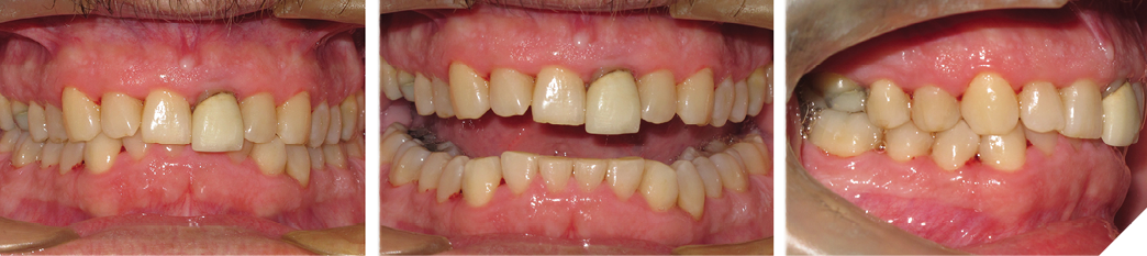 Conservative approach for the treatment of anterior tooth wear - Oral ...