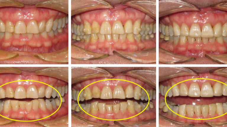 Conservative approach for the treatment of anterior tooth wear - Oral ...
