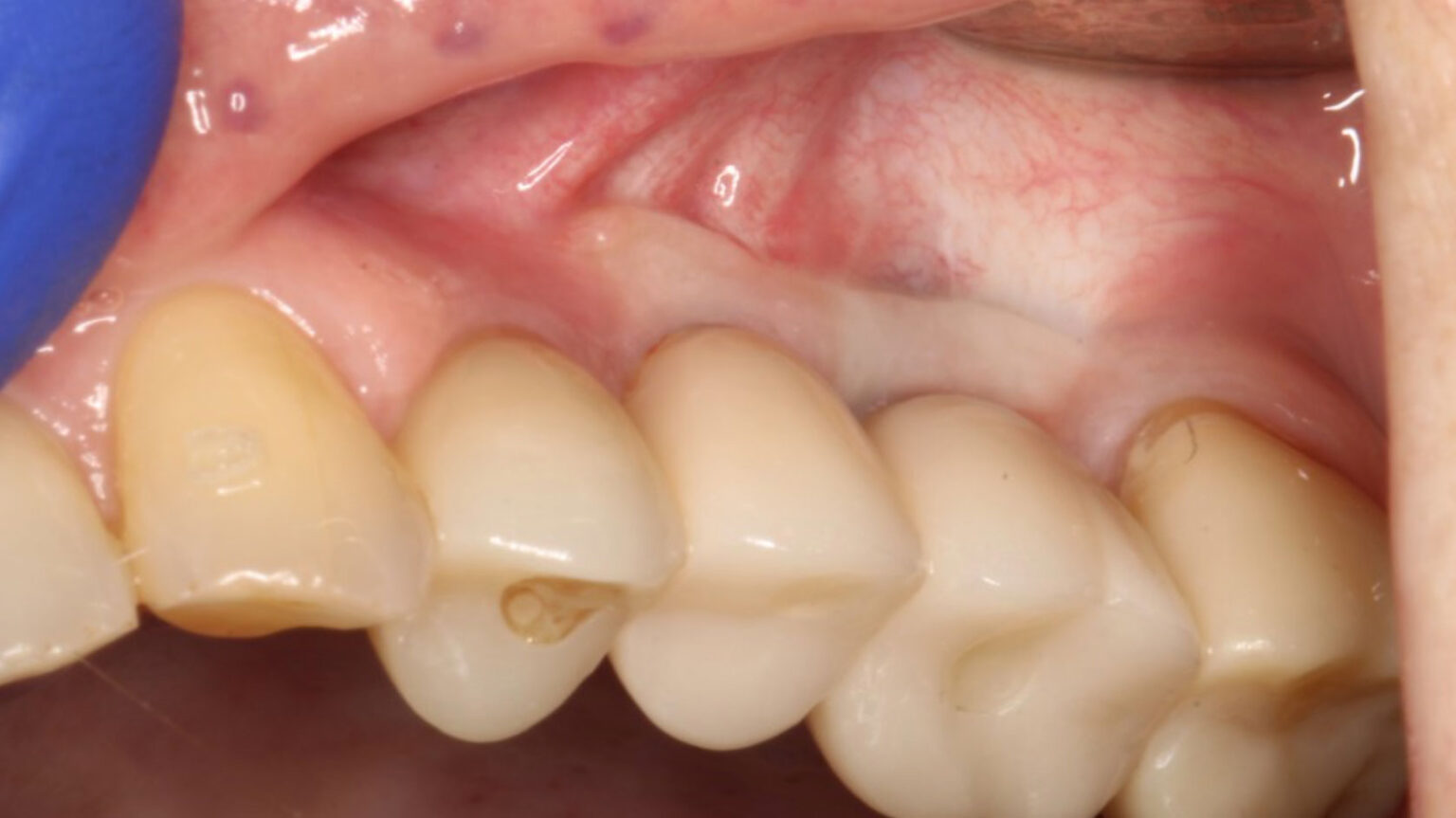 The importance of healthy, thick peri-implant soft tissue ...