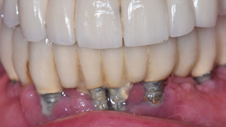 Silent progression: Full-arch implant peri-implantitis after 25 years ...