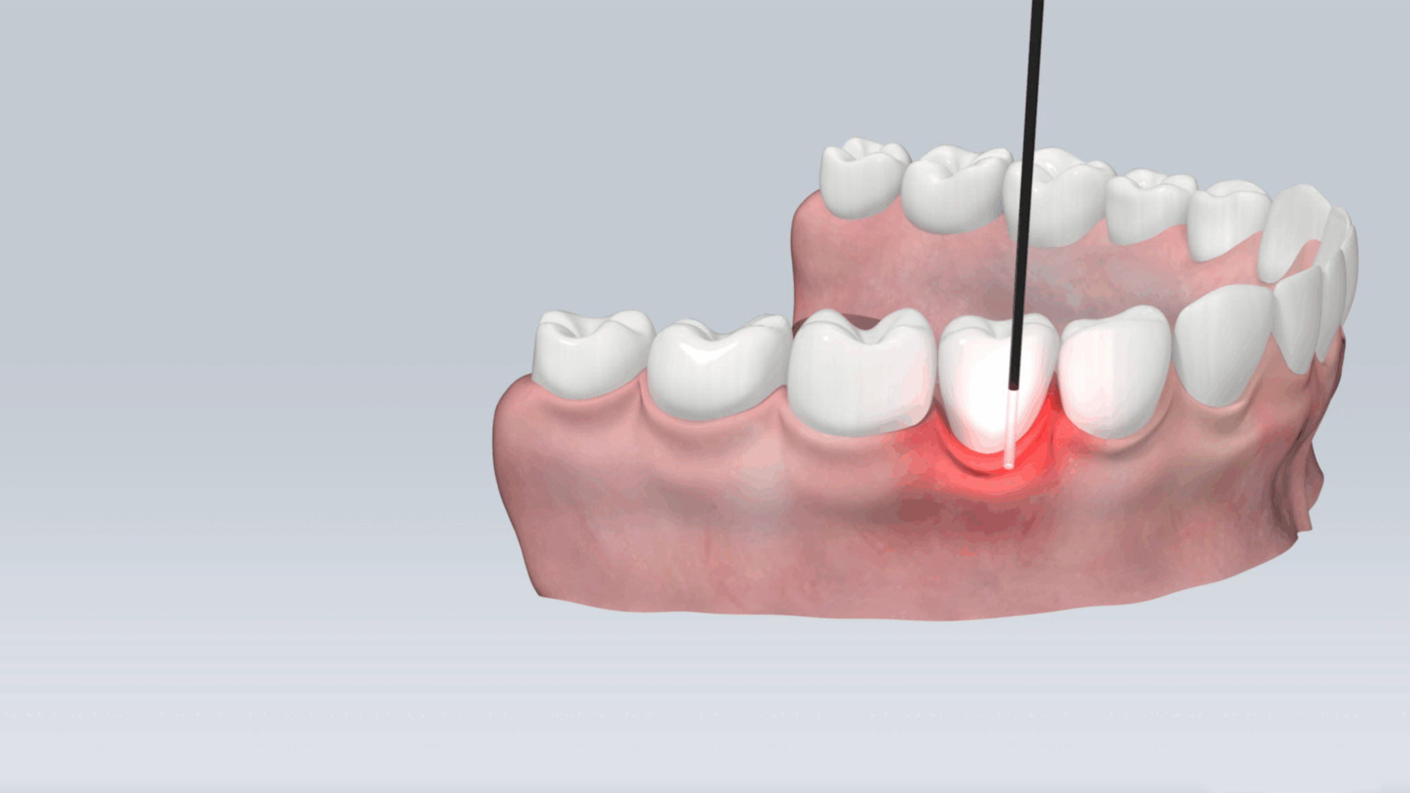 Glass: The secret superpower in dentistry - Oral Health Group