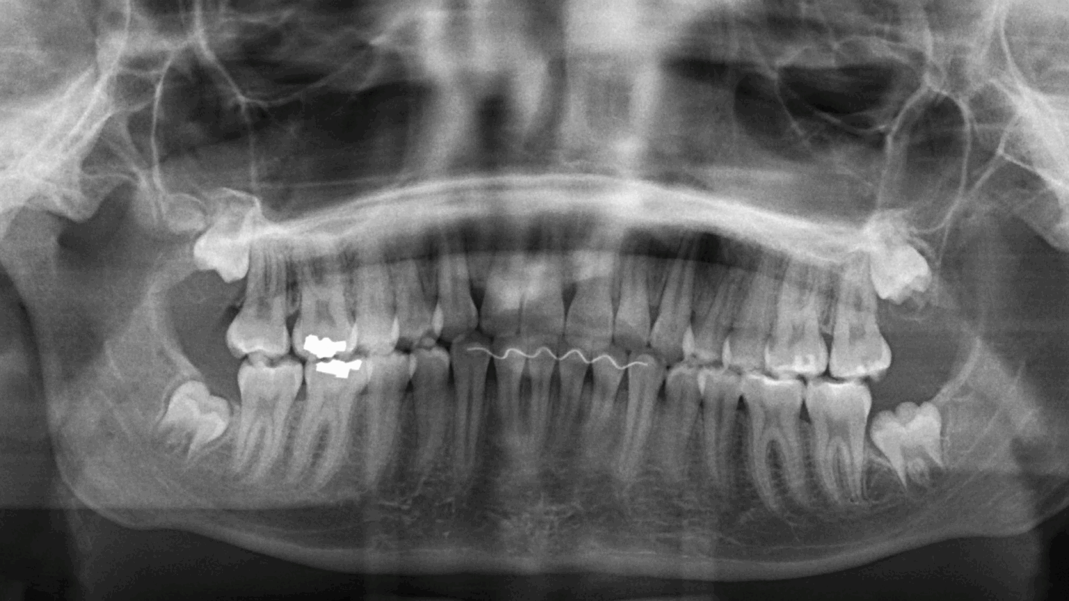 Late development of supernumerary maxillary molars - Oral Health Group