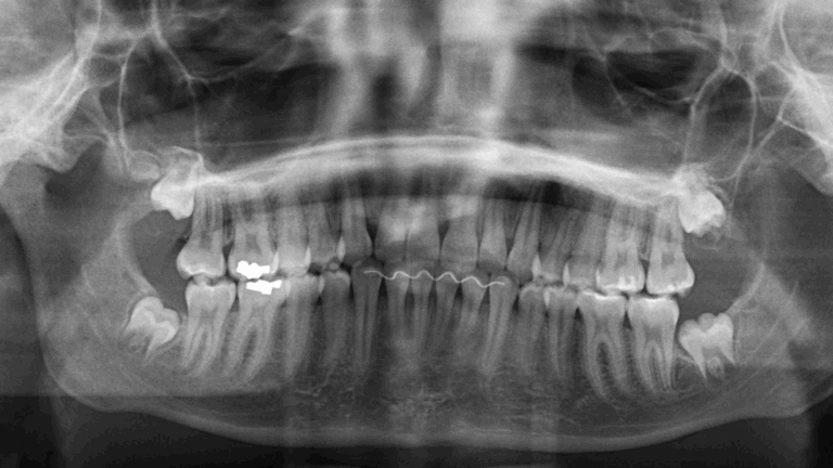 Late development of supernumerary maxillary molars - Oral Health Group