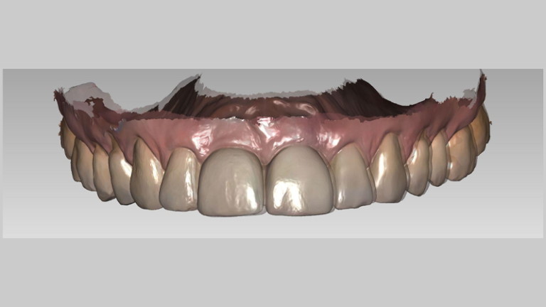 Layered intraoral scanning for longitudinal soft tissue monitoring ...